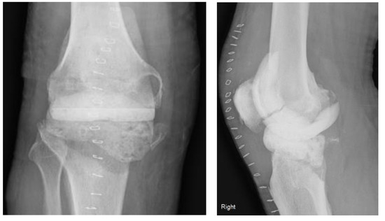 Revision Total Knee Arthroplasty Utilizing Threaded Pins in Cement for ...