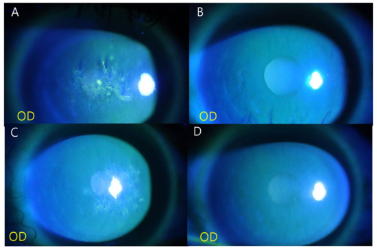 Bilateral Thygeson’s Superficial Punctate Keratitis with Dendritic ...