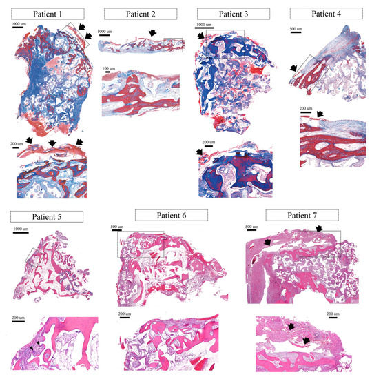 Bone Regenerative Potential of Cross-Linked Collagen Membrane in Peri ...