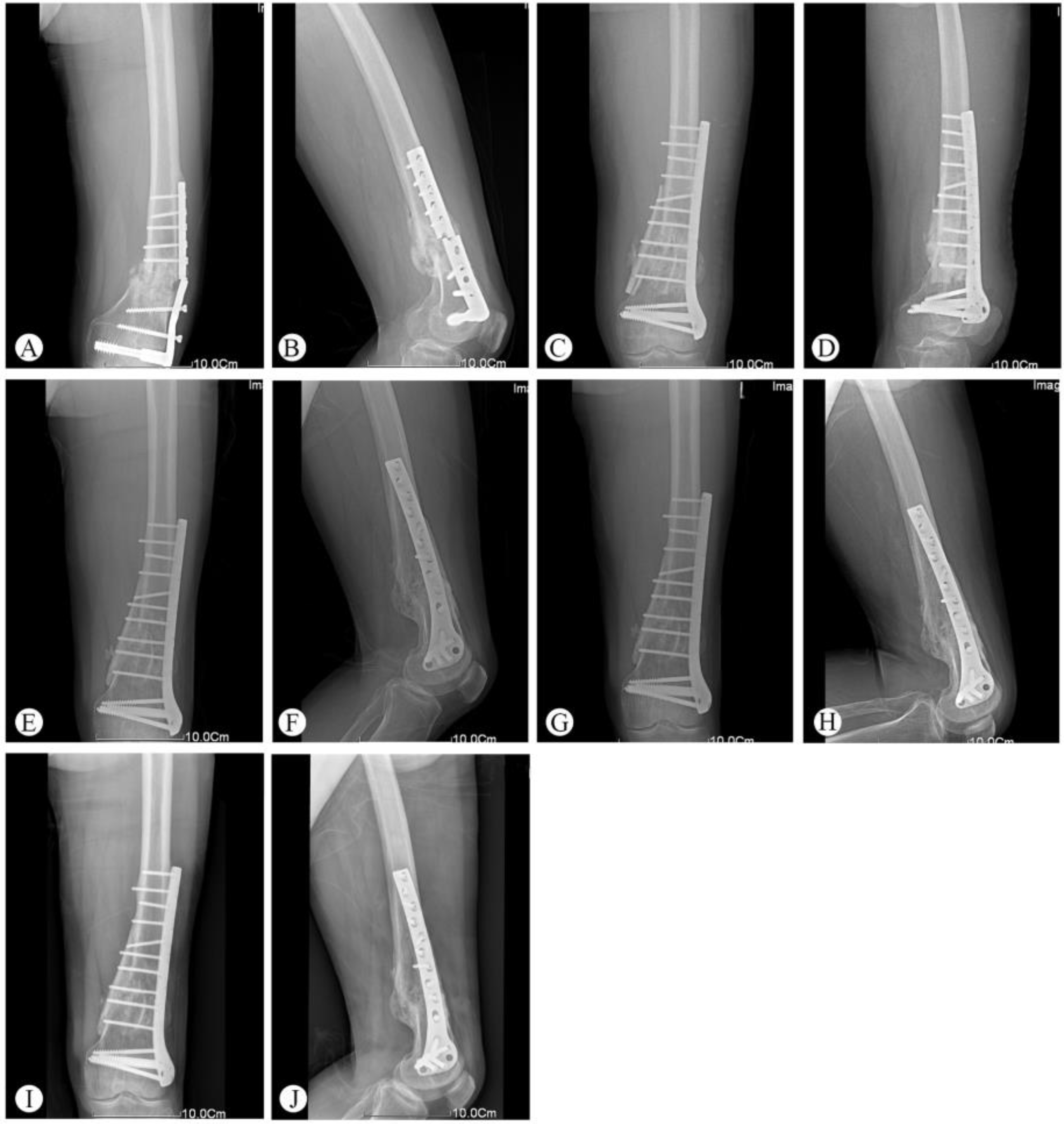Application of Cortical Bone Plate Allografts Combined with Less ...