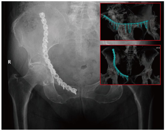 Third-Generation Dynamic Anterior Plate-Screw System for Quadrilateral Fractures: Digital Design ...