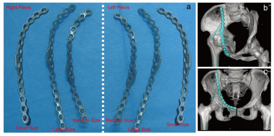 Third-Generation Dynamic Anterior Plate-Screw System for Quadrilateral ...