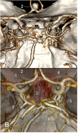 The Fetal Type of Posterior Cerebral Artery