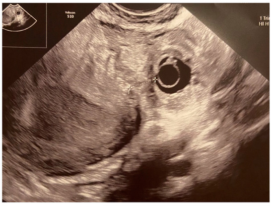 Interstitial Ectopic Pregnancy—Case Reports and Medical Management
