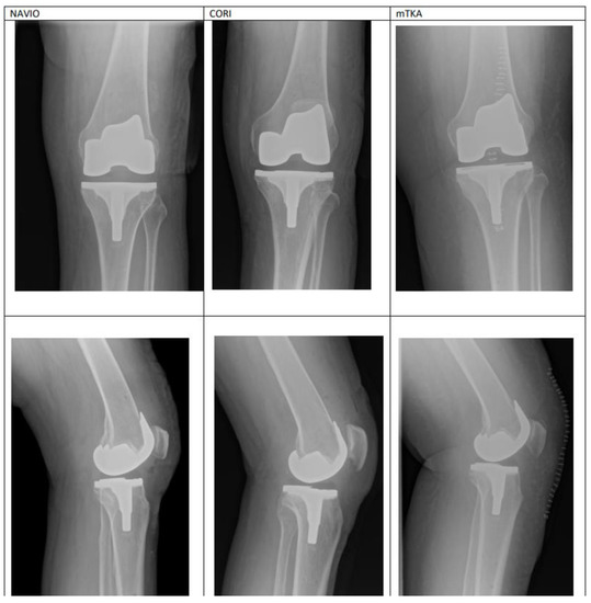 Robotic-Assisted Total Knee Arthroplasty Utilizing NAVIO, CORI ...