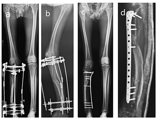 A Combination of Ilizarov Frame, Externalized Locking Plate and Tibia Bridging for an Adult with ...