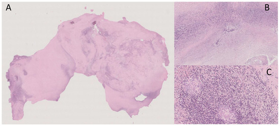 Abdominal Lymphadenopathies: Lymphoma, Brucellosis or Tuberculosis ...
