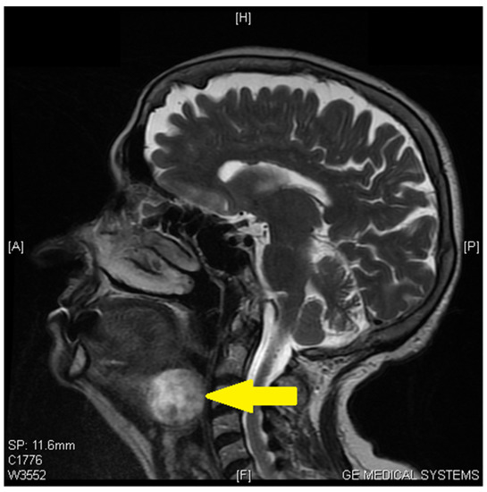 Tongue Base Ectopic Thyroid Tissue—Is It a Rare Encounter?