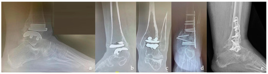 Tibiotalar and Tibiotalocalcaneal Arthrodesis with Paragon28 ...