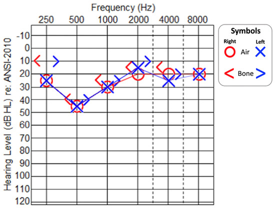 Temperature-Sensitive Auditory Neuropathy: Report of a Novel Variant of ...
