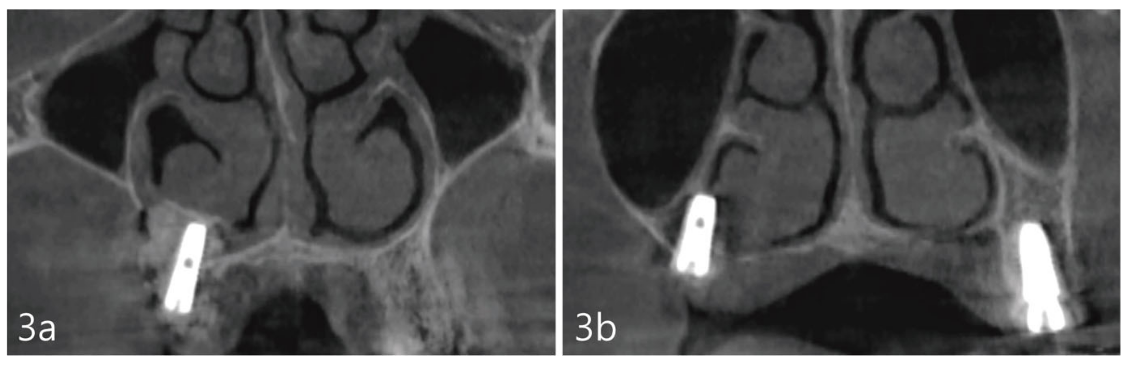 Successful Implant Placement via Simultaneous Nasal Floor Augmentation ...