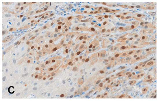 Medicina | Free Full-Text | HPV and RAD51 as Prognostic Factors for ...