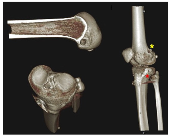 Outcomes of Combined Anterior Cruciate Ligament and Anterolateral ...