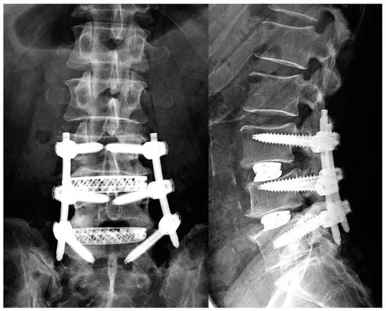 Vertebral Endplate Concavity in Lateral Lumbar Interbody Fusion ...
