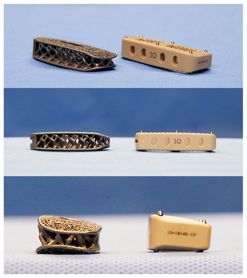Vertebral Endplate Concavity in Lateral Lumbar Interbody Fusion ...