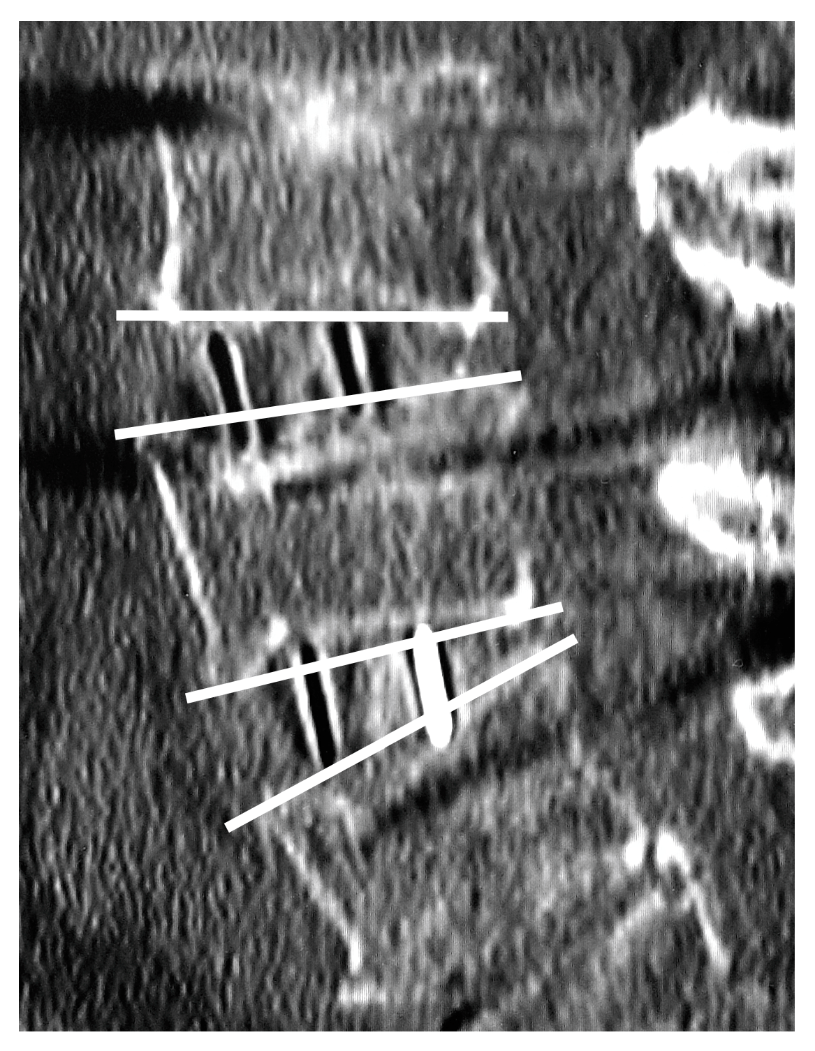 Vertebral Endplate Concavity in Lateral Lumbar Interbody Fusion ...