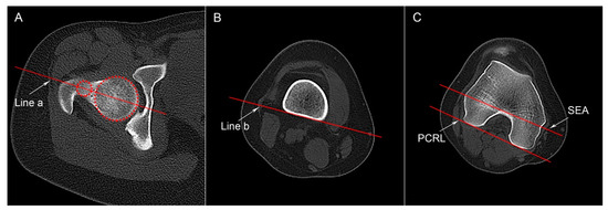 Femoral Anteversion Measured by the Surgical Transepicondylar Axis Is ...