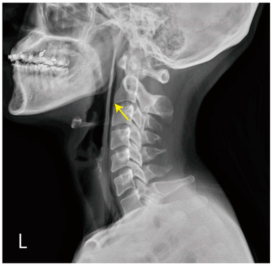 Point-of-Care Ultrasonography Helped to Rapidly Detect ...