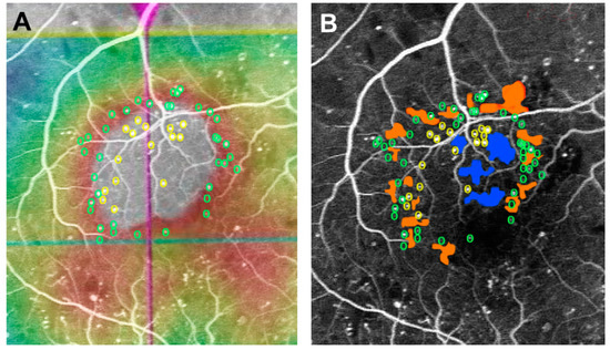 Role of Microaneurysms in the Pathogenesis and Therapy of Diabetic ...
