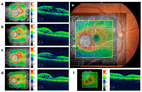 Role of Microaneurysms in the Pathogenesis and Therapy of Diabetic ...