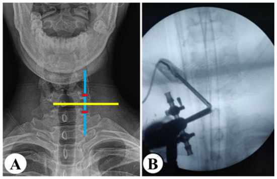 Comparison of Outcomes between Unilateral Biportal Endoscopic and ...
