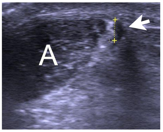 Combined Midportion Achilles and Plantaris Tendinopathy: A 1-Year ...