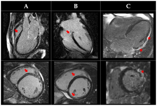 Cardiovascular Magnetic Resonance Imaging in Familial Dilated ...