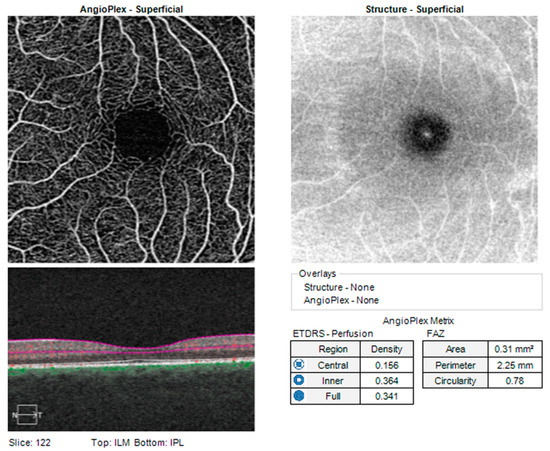 The Influence of Myopia on the Foveal Avascular Zone and Density of Blood Vessels of the Macula ...
