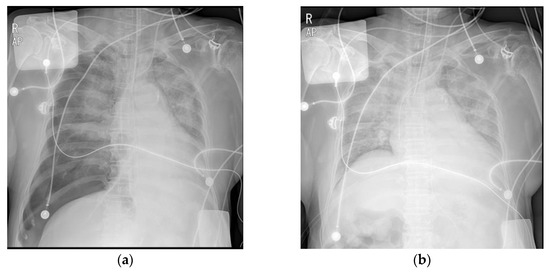 Unexpected Tension Pneumothorax after Double-Lumen Endotracheal ...