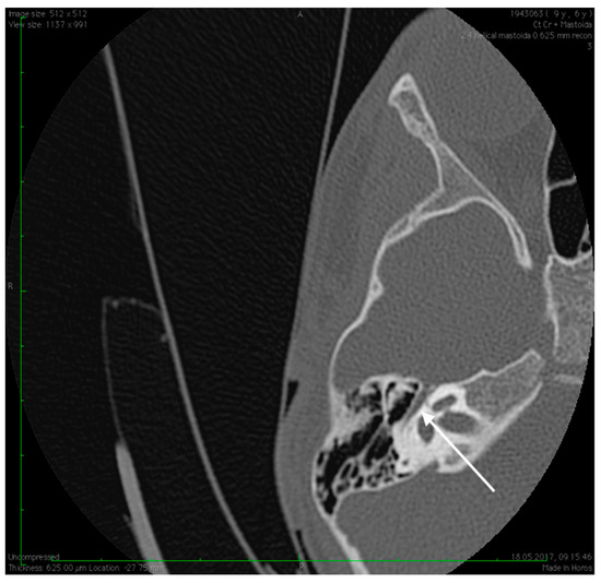 Persistent Stapedial Artery, Oval Window Atresia and Congenital Stapes ...
