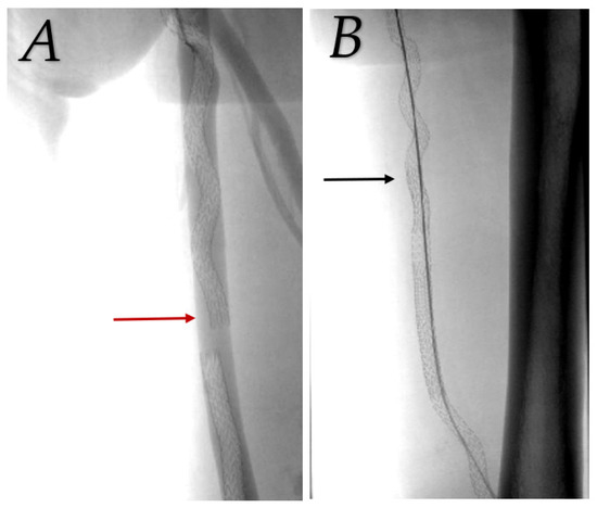 Three-Year Patency Results following Endovascular Transvenous ...