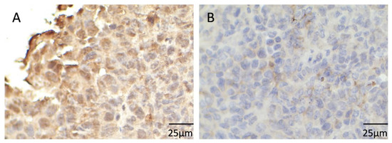 Correlation of INHBA Overexpression with Pathological Features ...