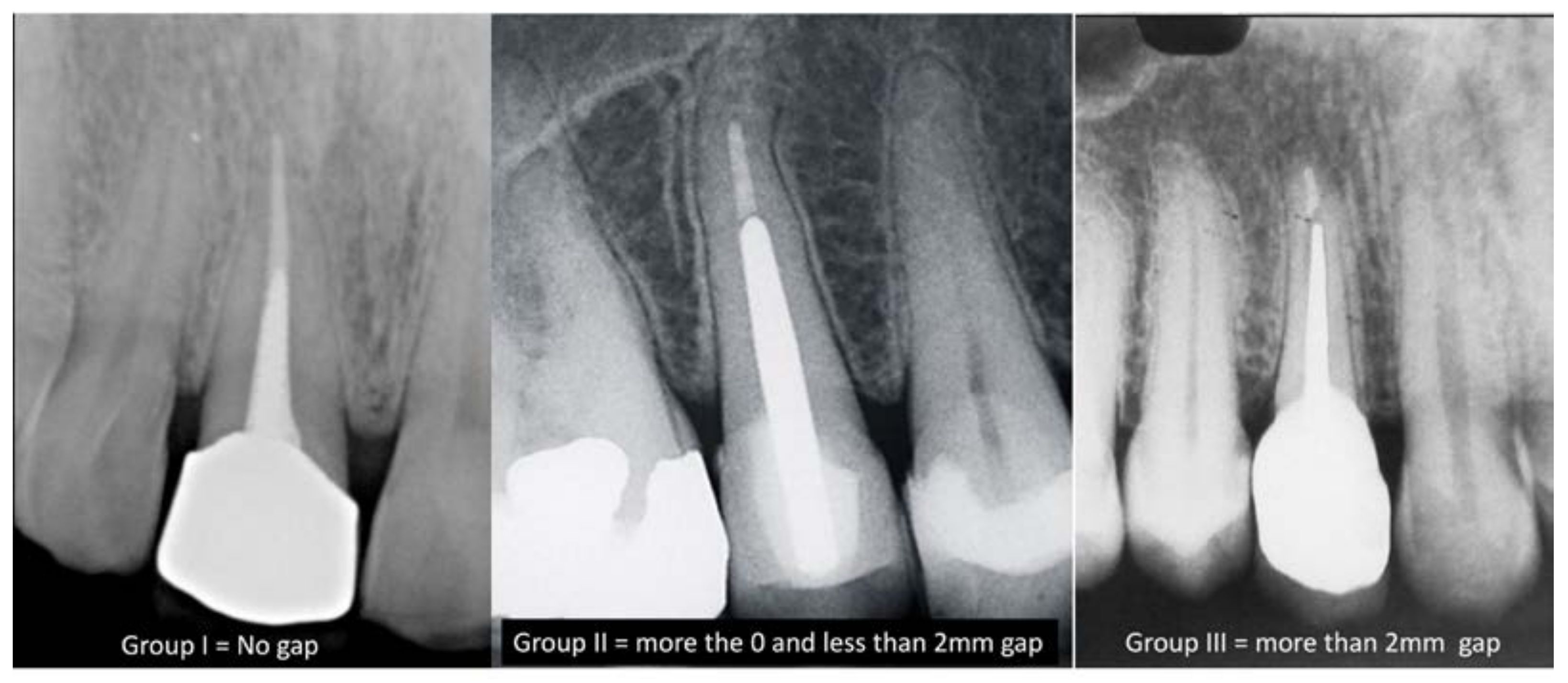 Medicina | Free Full-Text | Radiographic Evaluation of the Gap between ... Medicina | Free Full-Text | Radiographic Evaluation of the Gap between ...