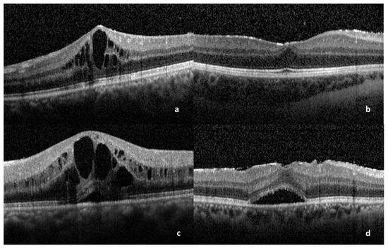 Correlation between Morphological Characteristics of Macular Edema and ...
