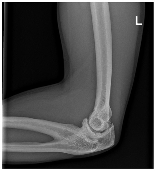 Congenital Proximal Radioulnar Synostosis in an Elite Athlete–Case Report