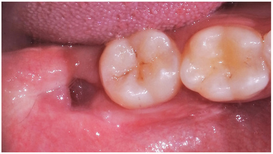 Post-Operative Complications and Risk Predictors Related to the ...