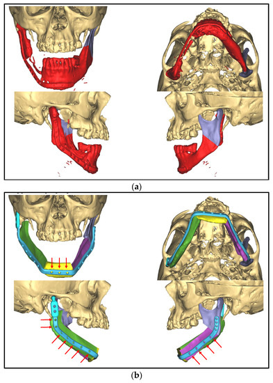 MRONJ of the Mandible—From Decortication to a Complex Jaw ...