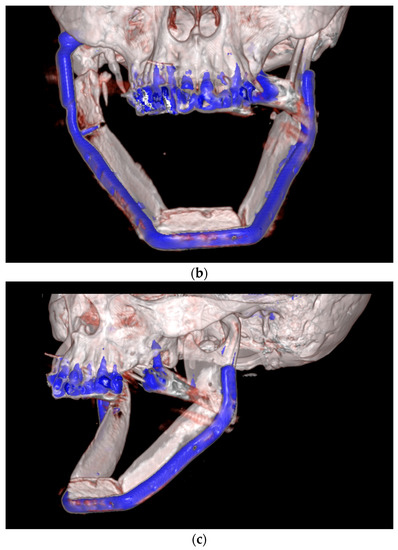 MRONJ of the Mandible—From Decortication to a Complex Jaw ...