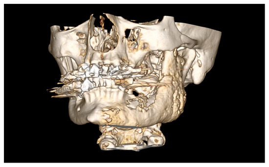 MRONJ of the Mandible—From Decortication to a Complex Jaw ...
