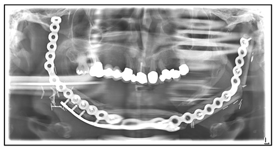 MRONJ of the Mandible—From Decortication to a Complex Jaw ...