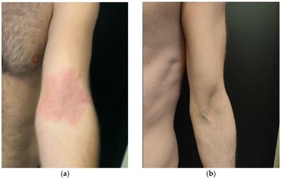 Atopic Dermatitis and Ulcerative Colitis Successfully Treated with ...