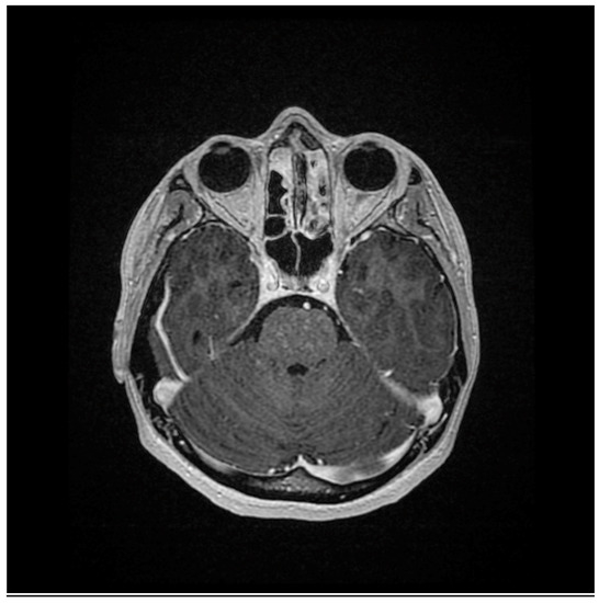 Spectrum of Autoimmune Diseases—Chronic Lymphocytic Inflammation with ...