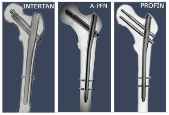 Intertrochanteric Femoral Fractures: A Comparison of Clinical and Radiographic Results with the ...