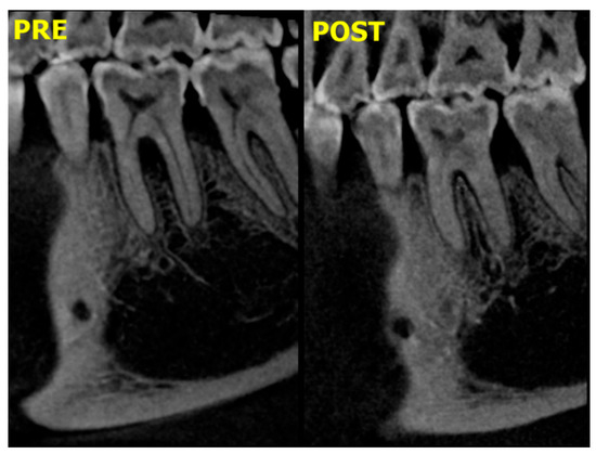 Clinical and Radiographic Evaluation of Third-Generation Pericardium ...