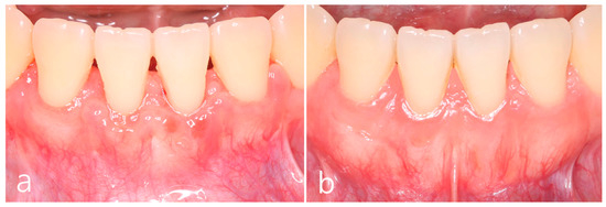 Periodontal Phenotype Modification Using Subepithelial Connective ...