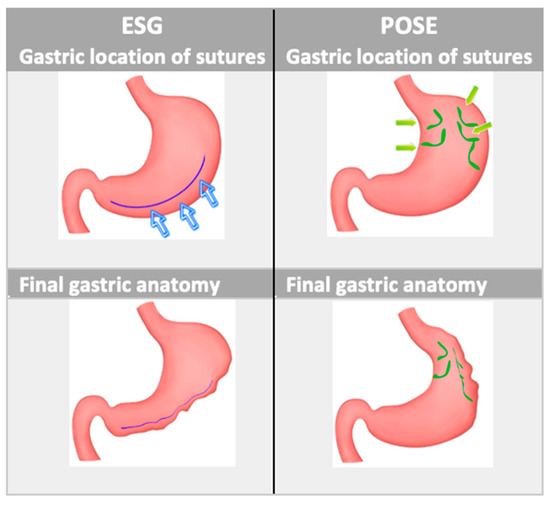 A Comprehensive Review on Bariatric Endoscopy: Where We Are Now and ...