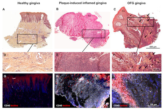 Gingival Orofacial Granulomatosis Clinical and 2D/3D Microscopy ...