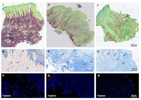 Gingival Orofacial Granulomatosis Clinical and 2D/3D Microscopy ...