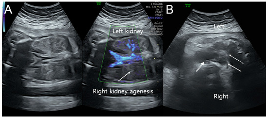 Prenatal Diagnosis of Fetal Obstructed Hemivagina and Ipsilateral Renal ...