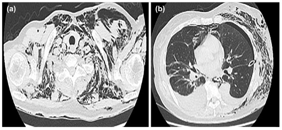 A Case of Pneumothorax Ex Vacuo Associated with COVID-19